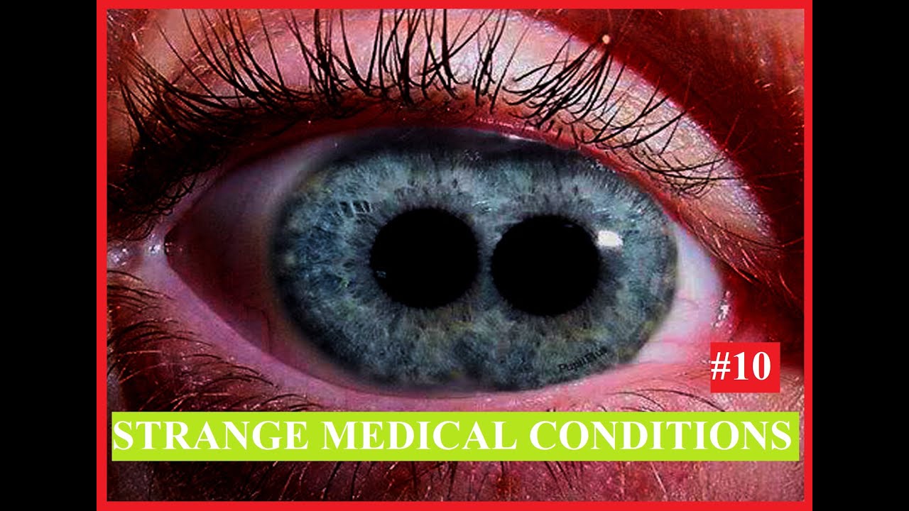 Strange medical conditions in the world | tamil - YouTube