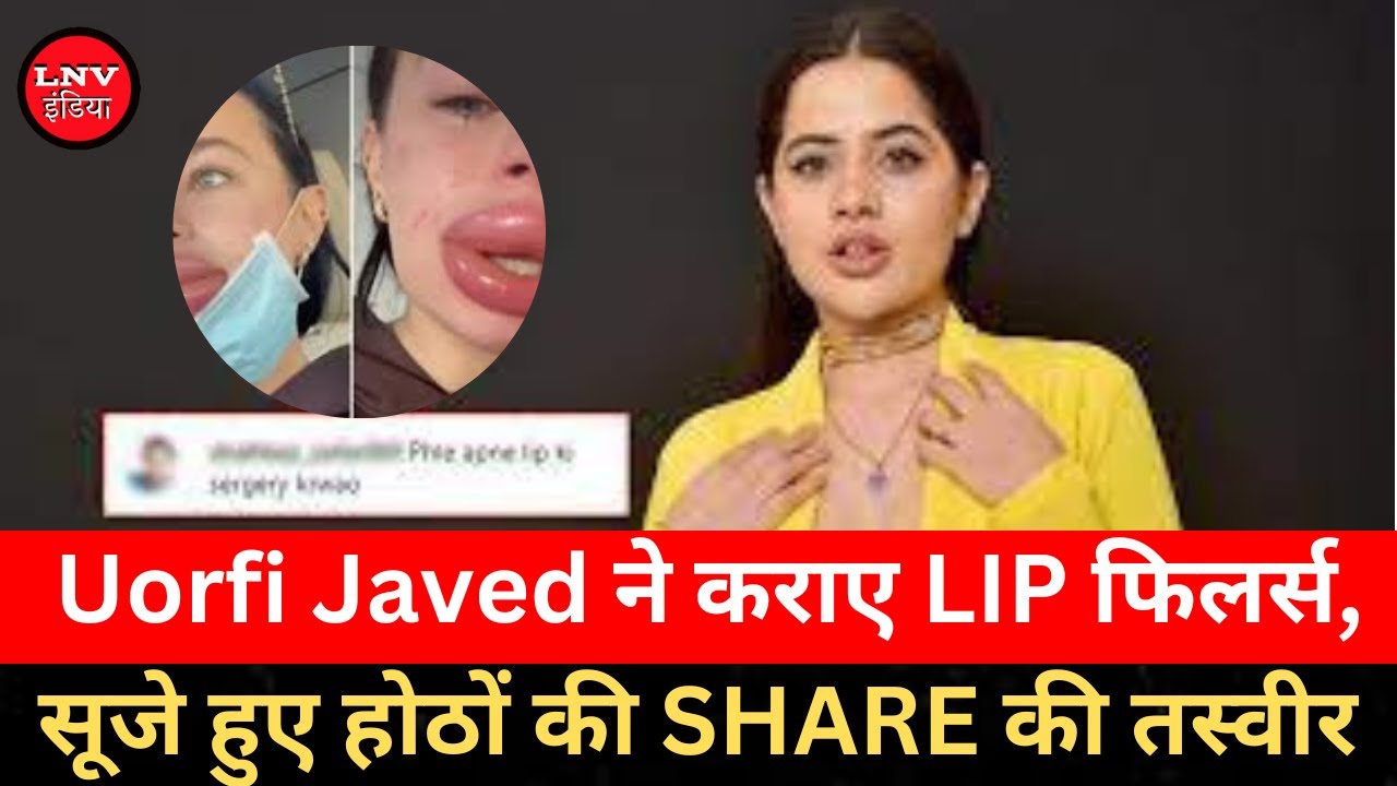 खूबसूरत दिखने के लिए Uorfi Javed ने कराए LIP फिलर्स, सूजे हुए होठों की ...