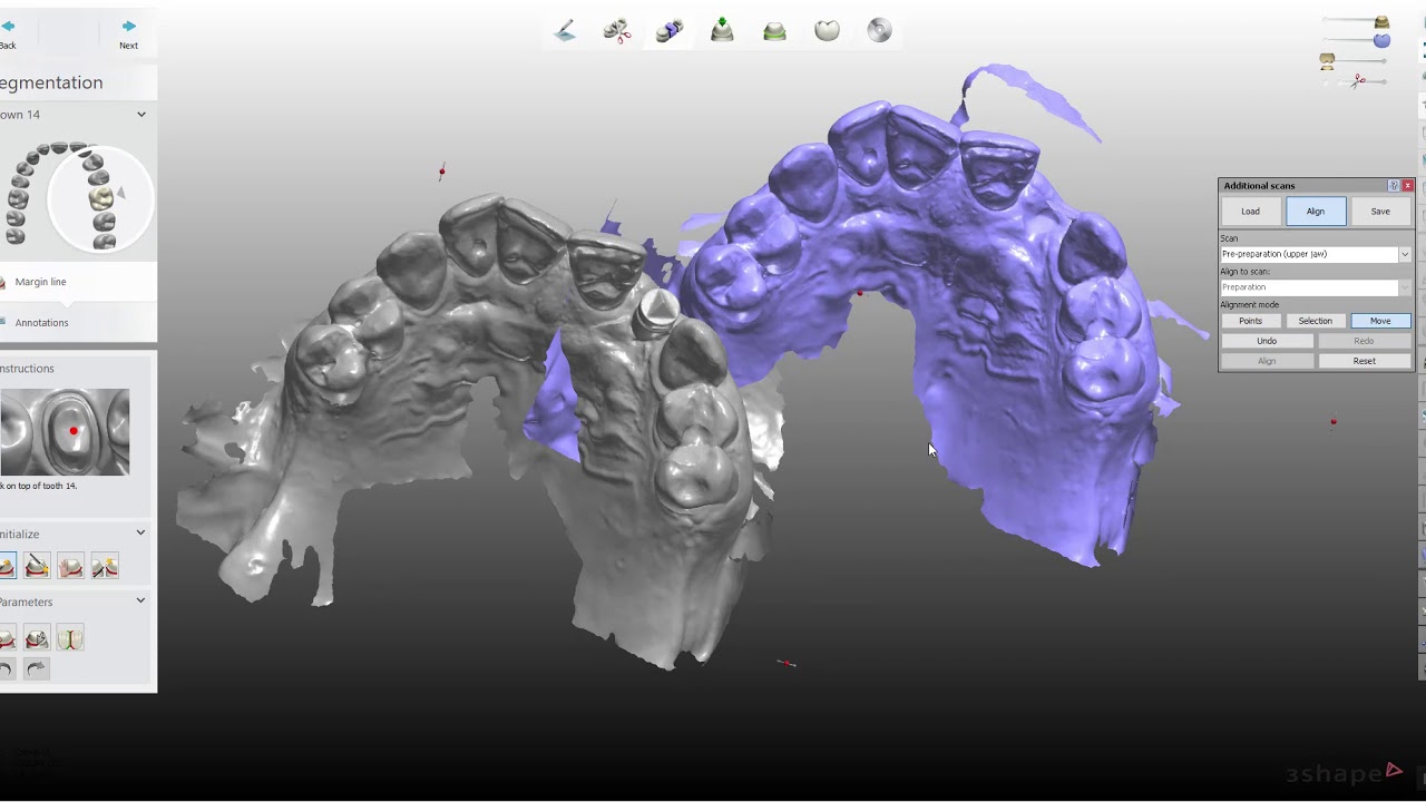 3Shape Scan Alignment - YouTube