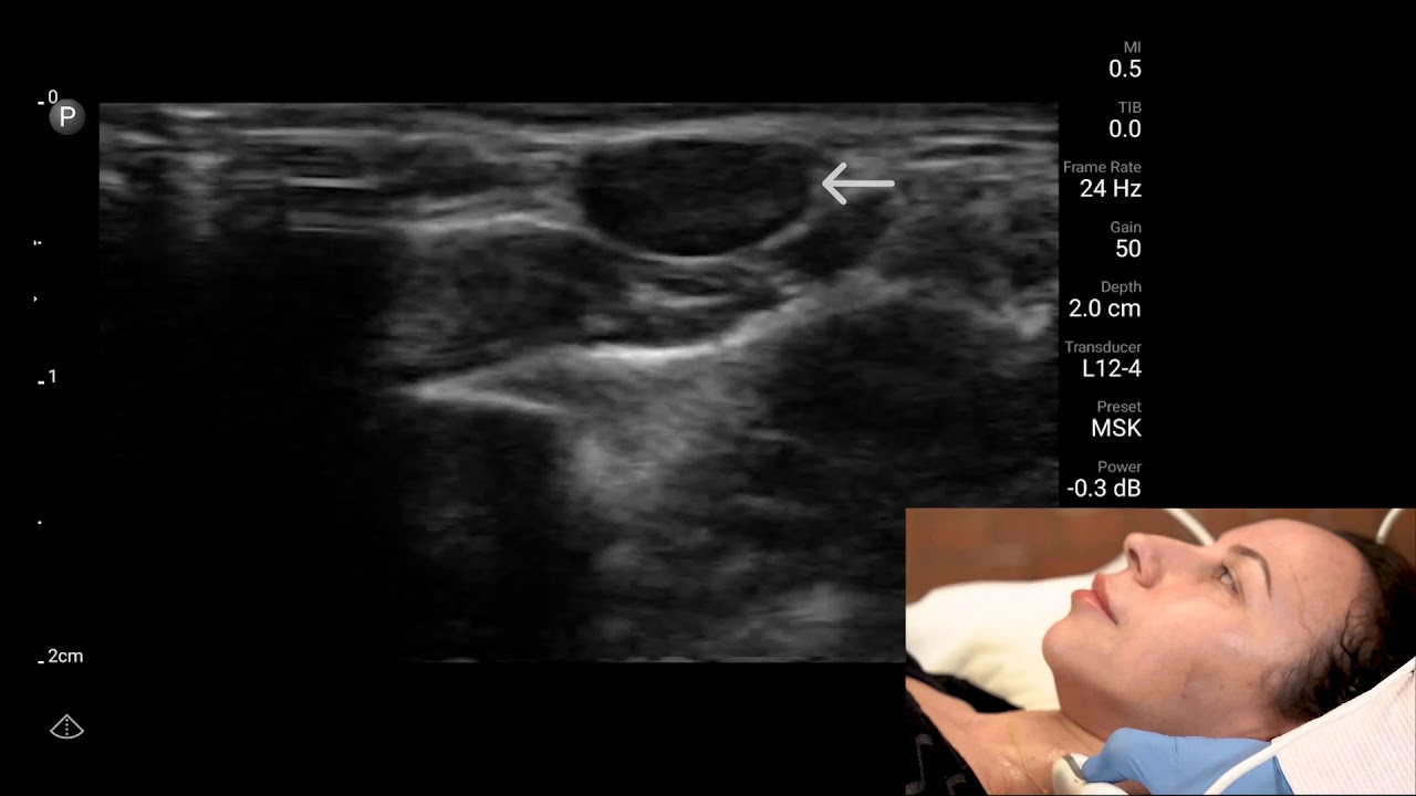 Botulinum Toxin Injections - Part 2 - YouTube