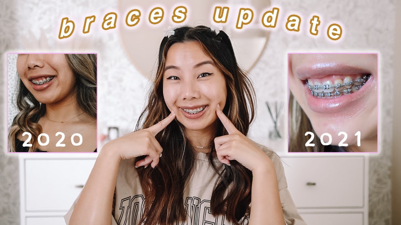 the last braces update before getting my braces off! - YouTube