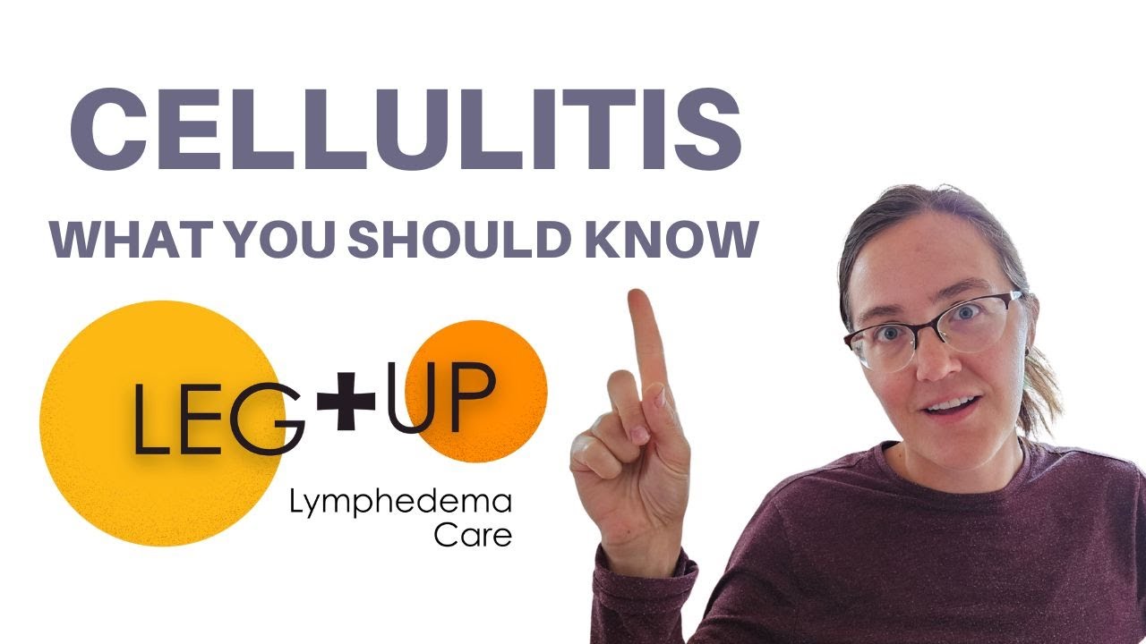 Cellulitis: Causes, Prevention, and Treatment for Lymphedema Patients ...