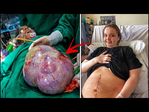 Hamile Olduğunu Sandılar Ama Doktorlar Karnından Çıkan Şeye İnanamadılar