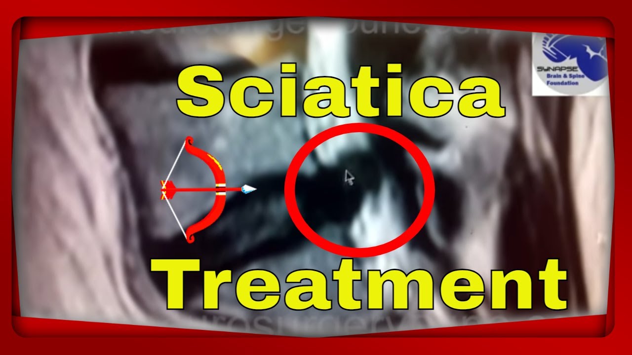 Sciatica treatment-Dr Jaydev Panchwagh demonstrates Microscopic Spine ...