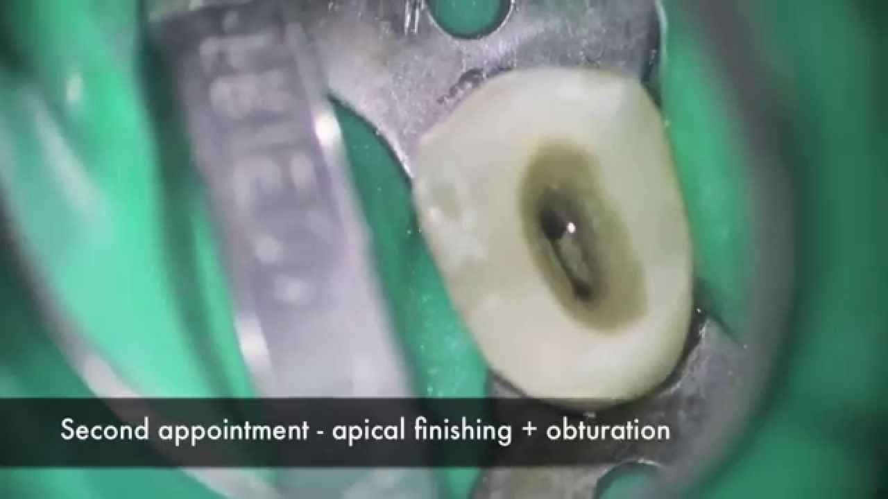 Premolar with three canals - YouTube