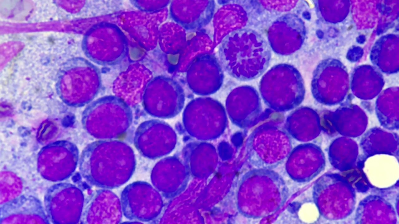 Lymphoma cytology - YouTube