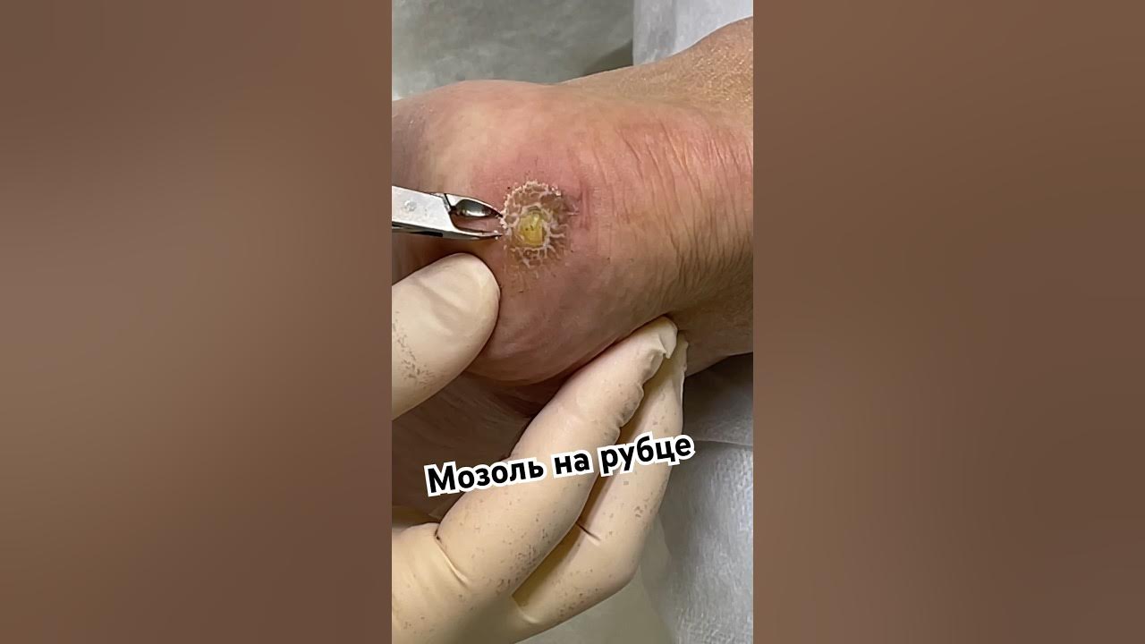 Торчащая мозоль на пятке #мозоли #подолог - YouTube