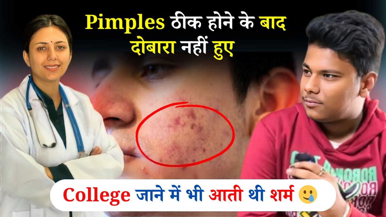 1 महीने में हुए Acne, Pimples ठीक 🔥 | Pimples 100% Permanent Solution ...