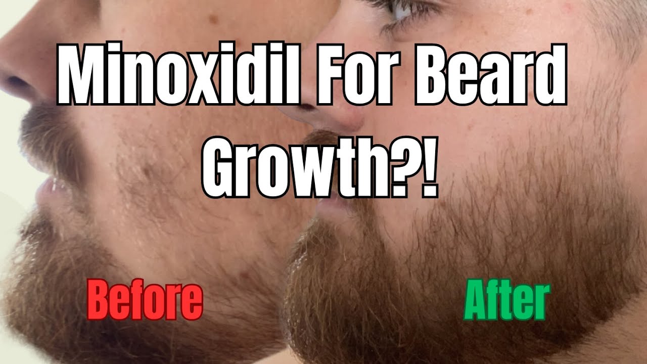 1 Year of Using Minoxidil For Beard Growth - Minoxidil for Beard Before ...