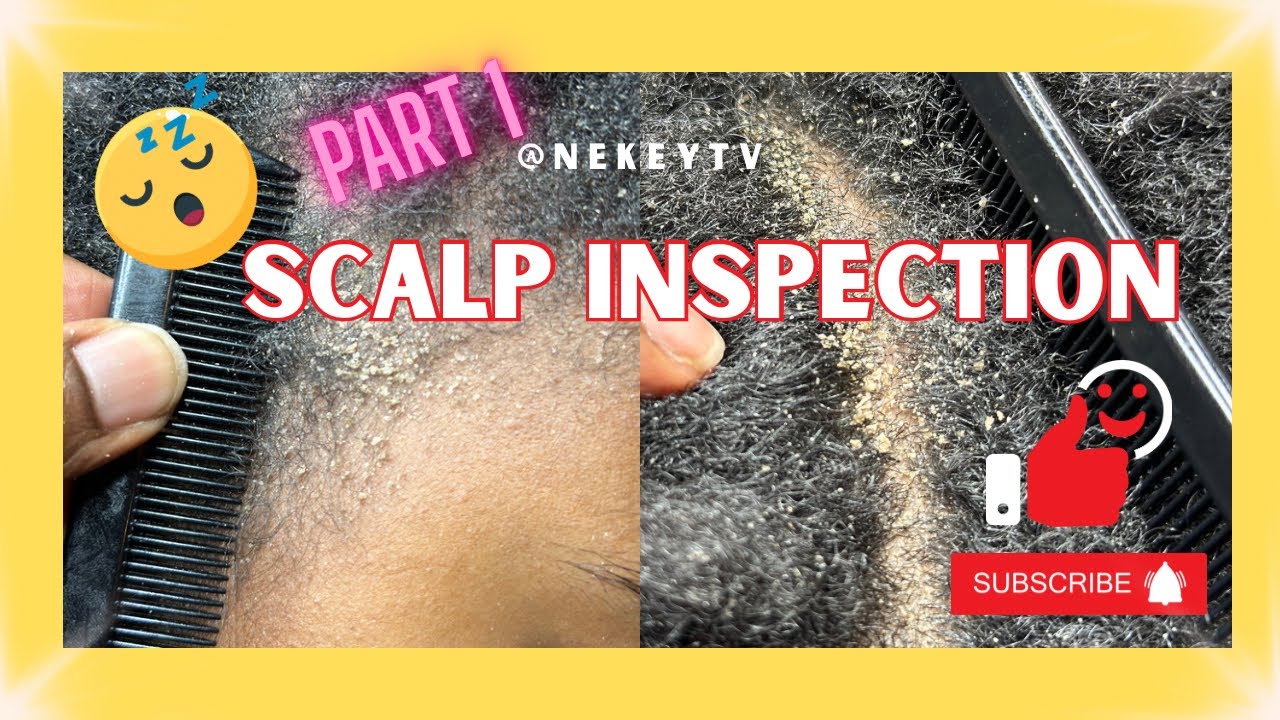 PART 1 Scalp Inspection with LOTS of Dandruff #naturalhair #dandruff # ...