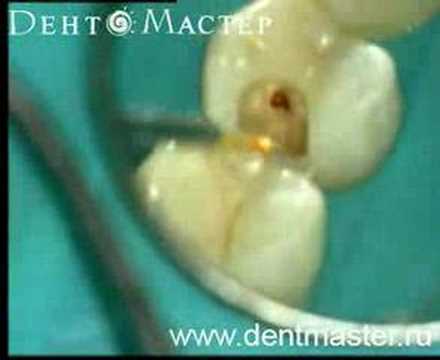 Direct pulp covering - YouTube