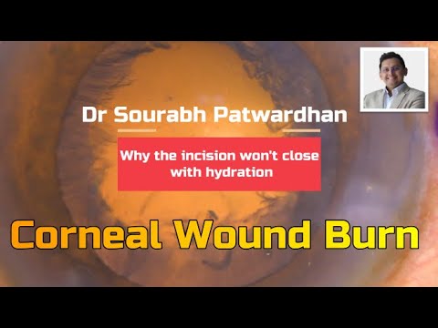 Corneal wound burn : Cause,Treatment,Prevention Dr Sourabh Patwardhan ...