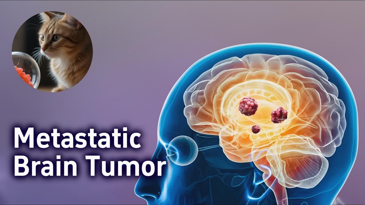 USMLE, Brain Metastases vs Primary Brain Tumor, First Aid Step 1 Case ...