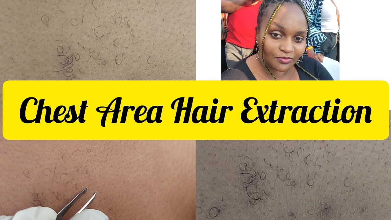 Ingrown Hair Extraction Episode 1/ Chest Area/ PCOS Symptoms - YouTube