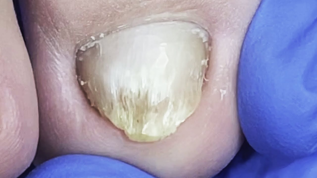 The ingrown fingernail of the thumb is painful - YouTube