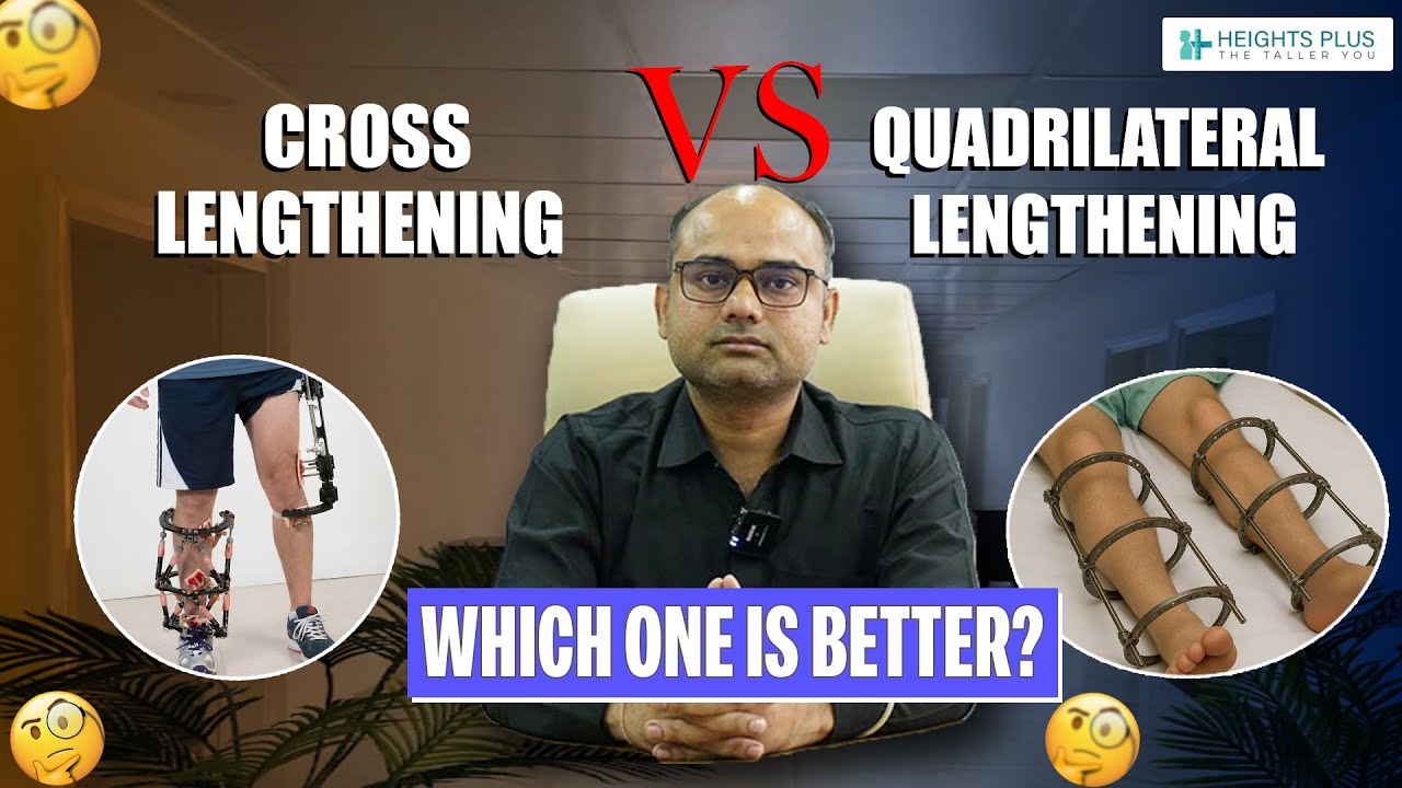 Cross vs. Bilateral Leg Lengthening: Best Surgery Method to Gain 13-15 ...