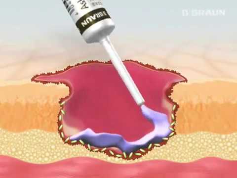 Manejo de heridas infectadas con Askina® Calgitrol® Paste y ProntoVet ...