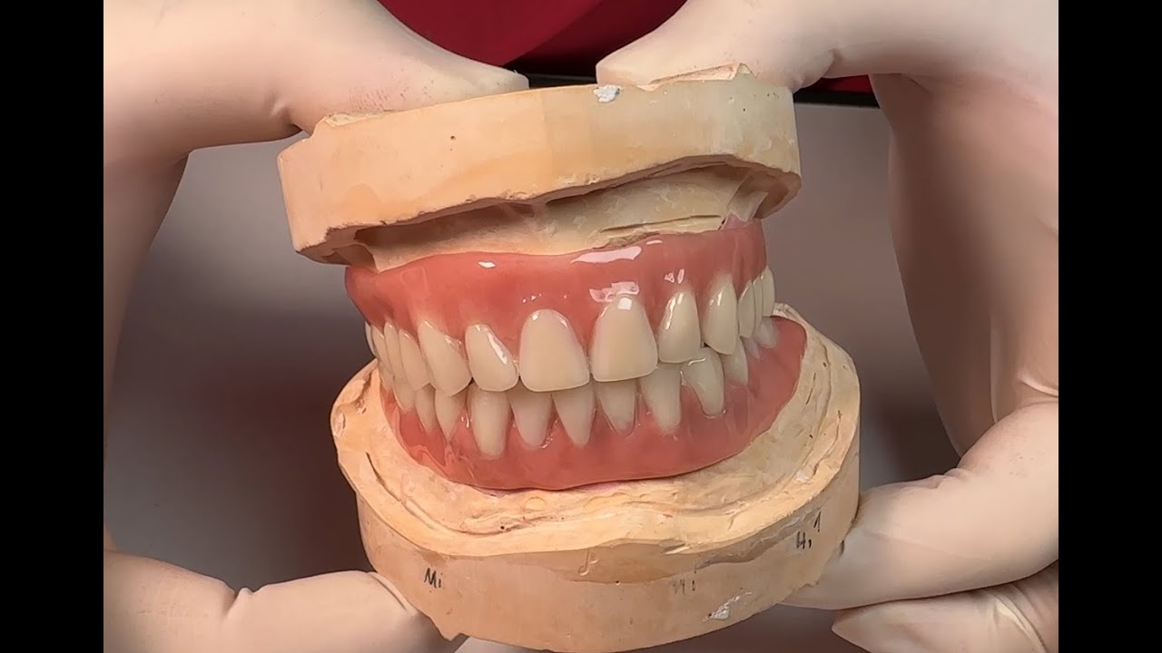 Frictie-Steg prothese, muurvast, klikgebit, gehemelte vrije prothese ...