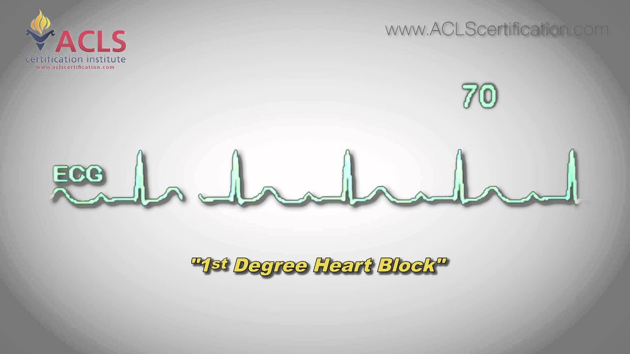 First Degree Heart Block by ACLS Certification Institute - YouTube