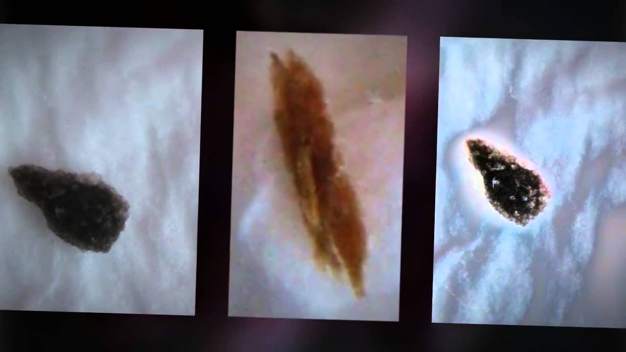 MEET THE MORGELLONS 2013 (DELUSIONALPARASITOSIS?) - YouTube