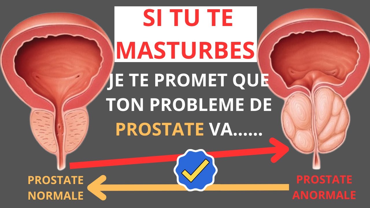 Tout ce que vous devez savoir sur les problèmes de prostate 🌟 - YouTube