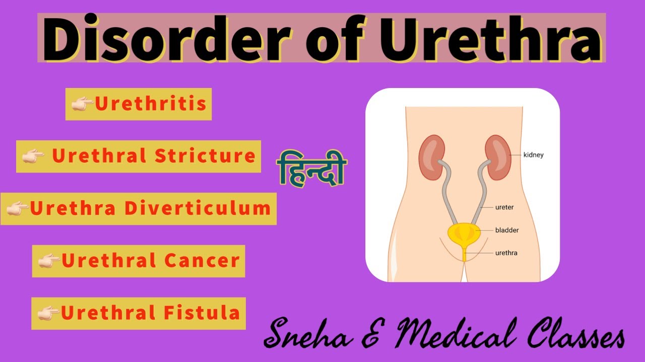 Disorder of Urethra !! Medical Surgical !! Urinary System Disorder ...