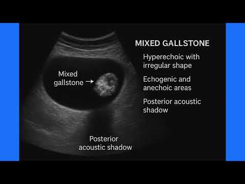 Types of Gallstones | Ultrasound Diagnosis and Features Explained - YouTube