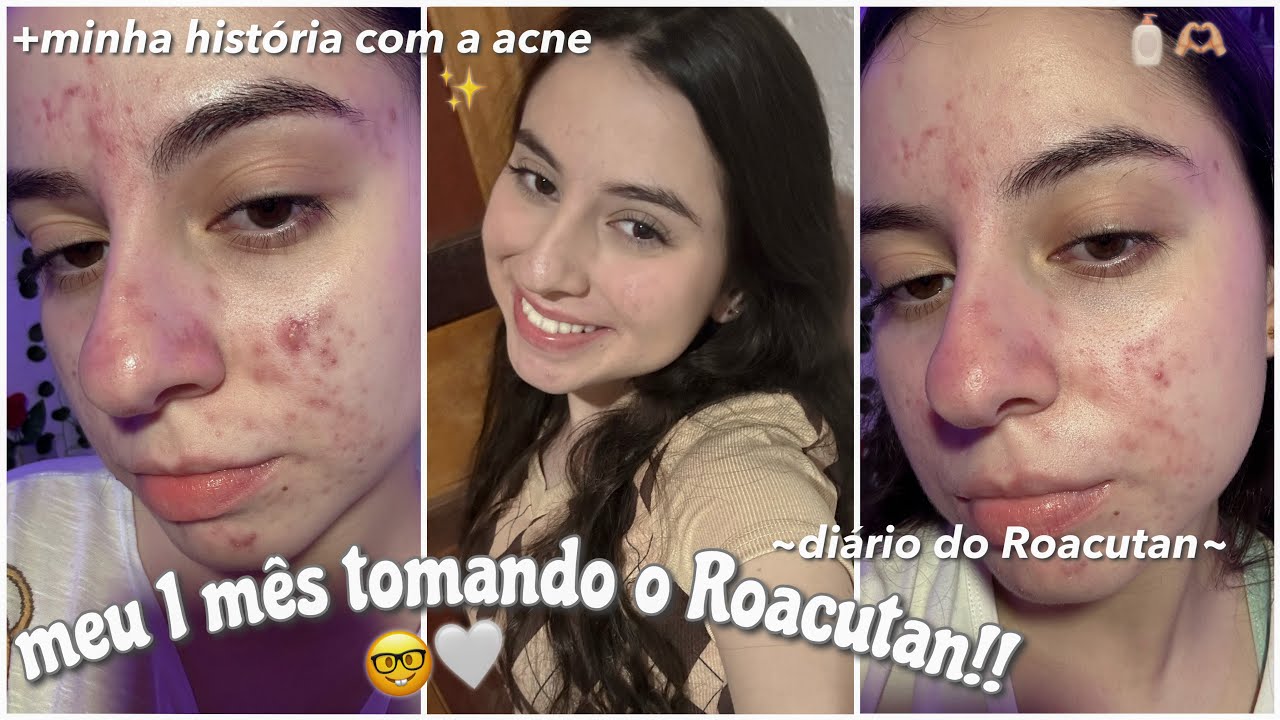 MEU PRIMEIRO MÊS TOMANDO O ROACUTAN! |diário do Roacutan +minha ...