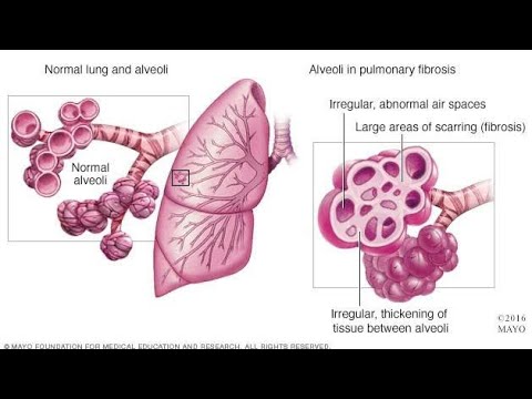 interstitial pulmonary fibrosis - YouTube
