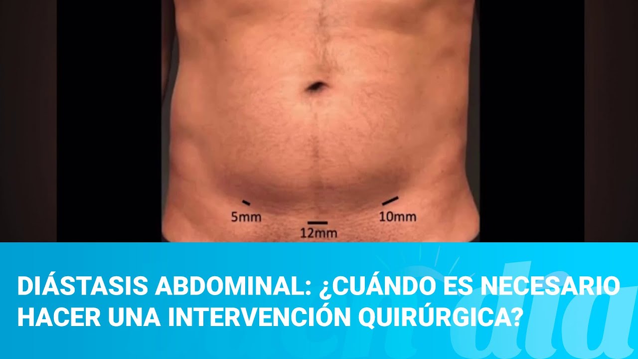 Diástasis abdominal: ¿Cuándo es necesario hacer una intervención ...