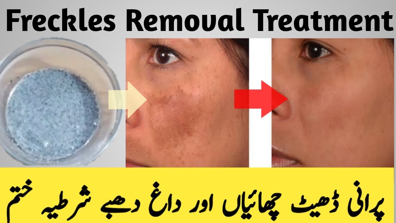 Treatment for Freckles, Pigmentation and Dark Spots | Anti Freckles ...