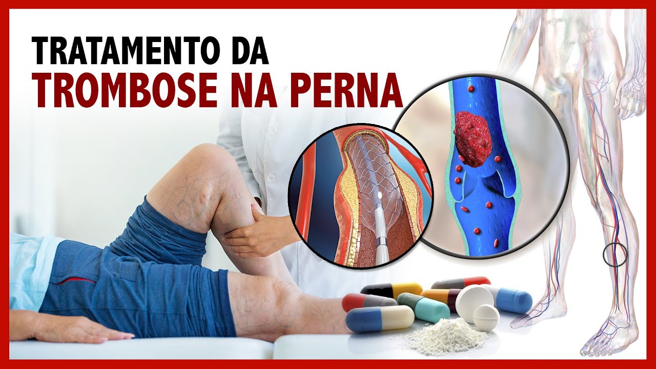 Tratamento da trombose na perna - YouTube