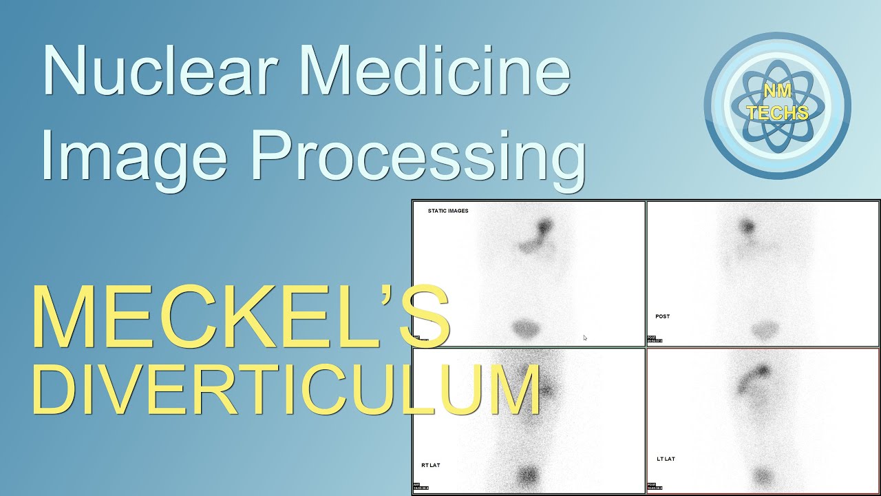 Meckel's Diverticulum image Processing, in nuclear medicine - YouTube