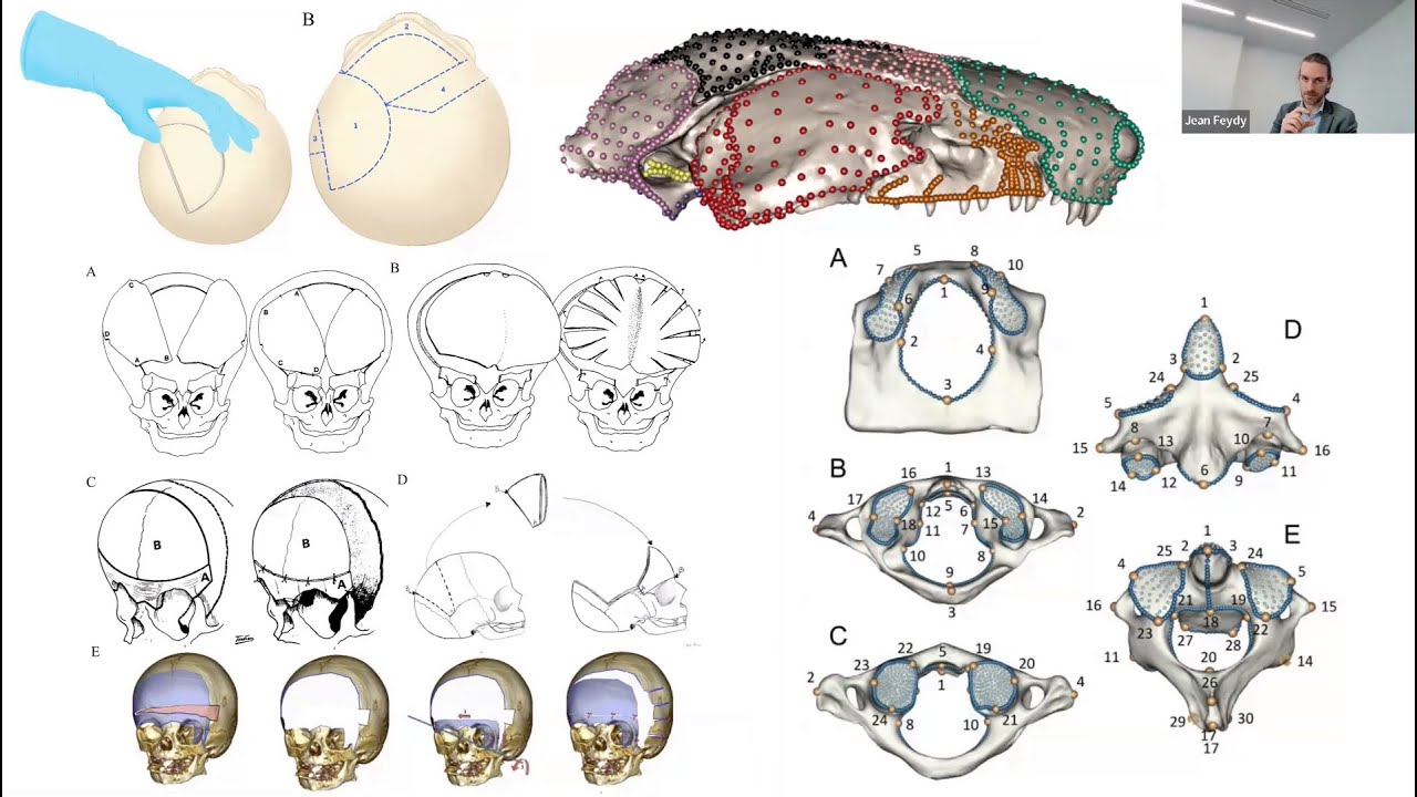 Skull fusion and surgery - Maxime Taverne - Shape seminar - YouTube
