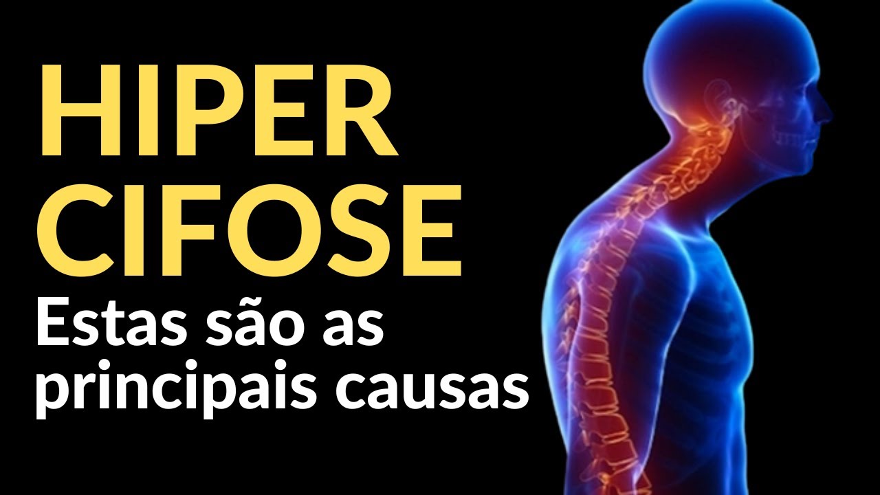HIPERCIFOSE | ESTAS SÃO AS PRINCIPAIS CAUSAS DA HIPERCIFOSE - YouTube