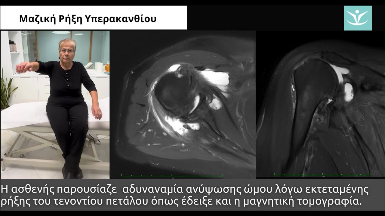 Ανάστροφη Αρθροπλαστική Ώμου σε Μαζική Ρήξη Υπερακανθίου - YouTube