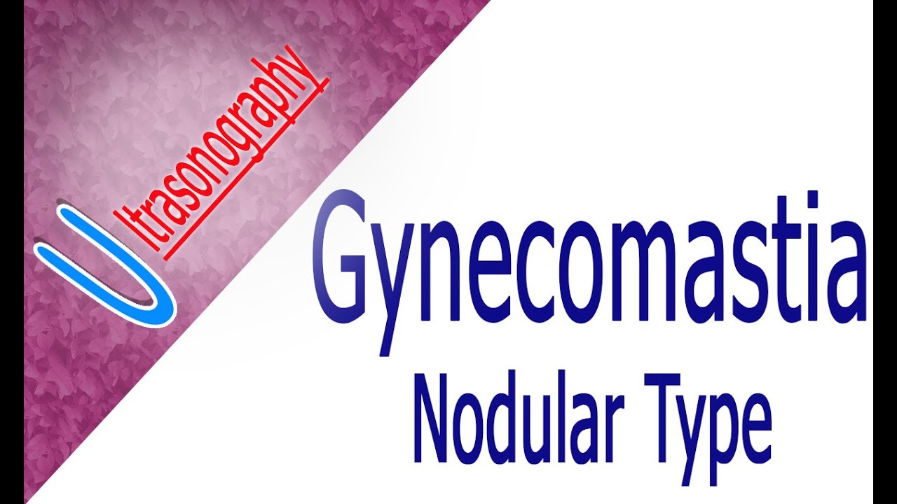 Gynecomastia Nodular type I ultrasound case - YouTube