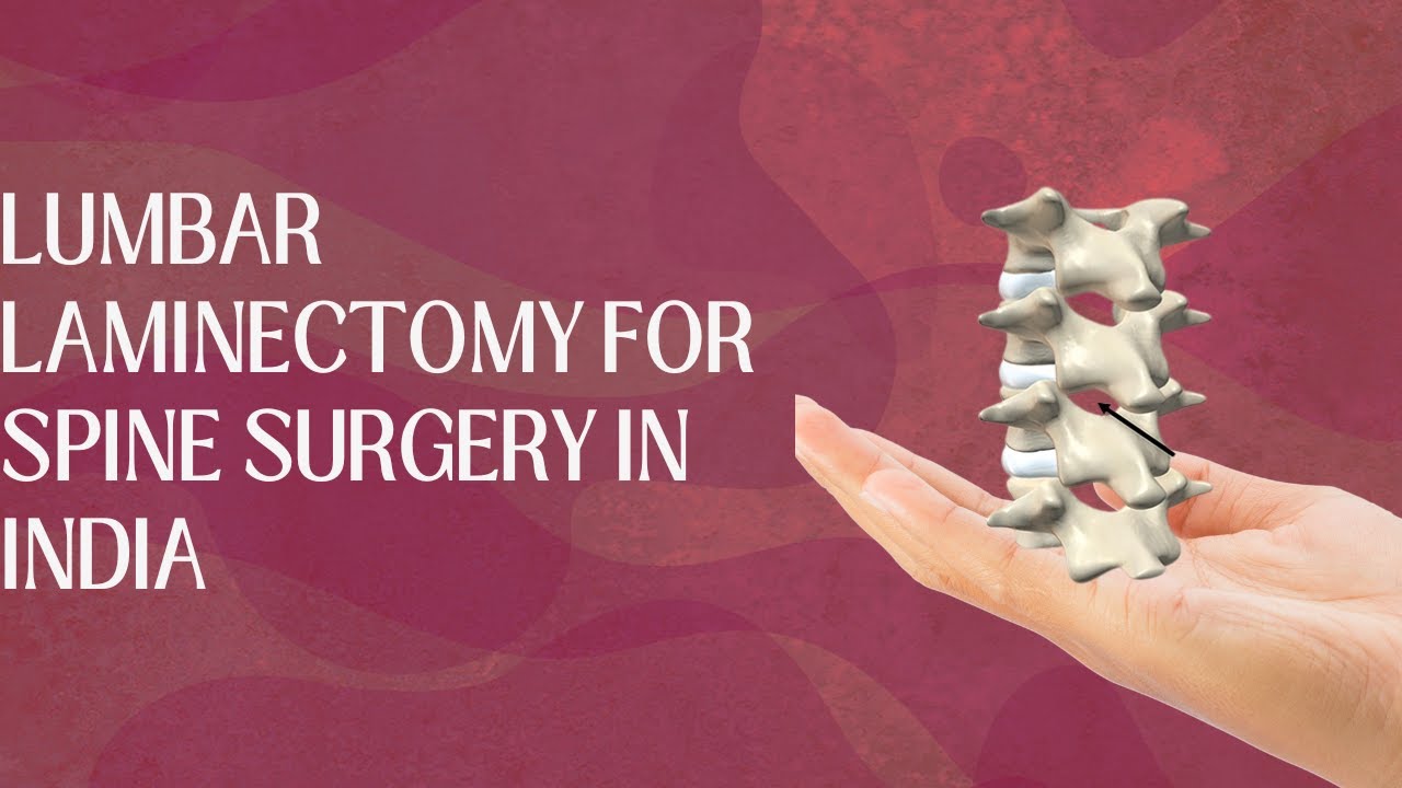 Ultimate Guide to Lumbar Laminectomy for Spine Surgery in India | #cureuhealthcare - YouTube