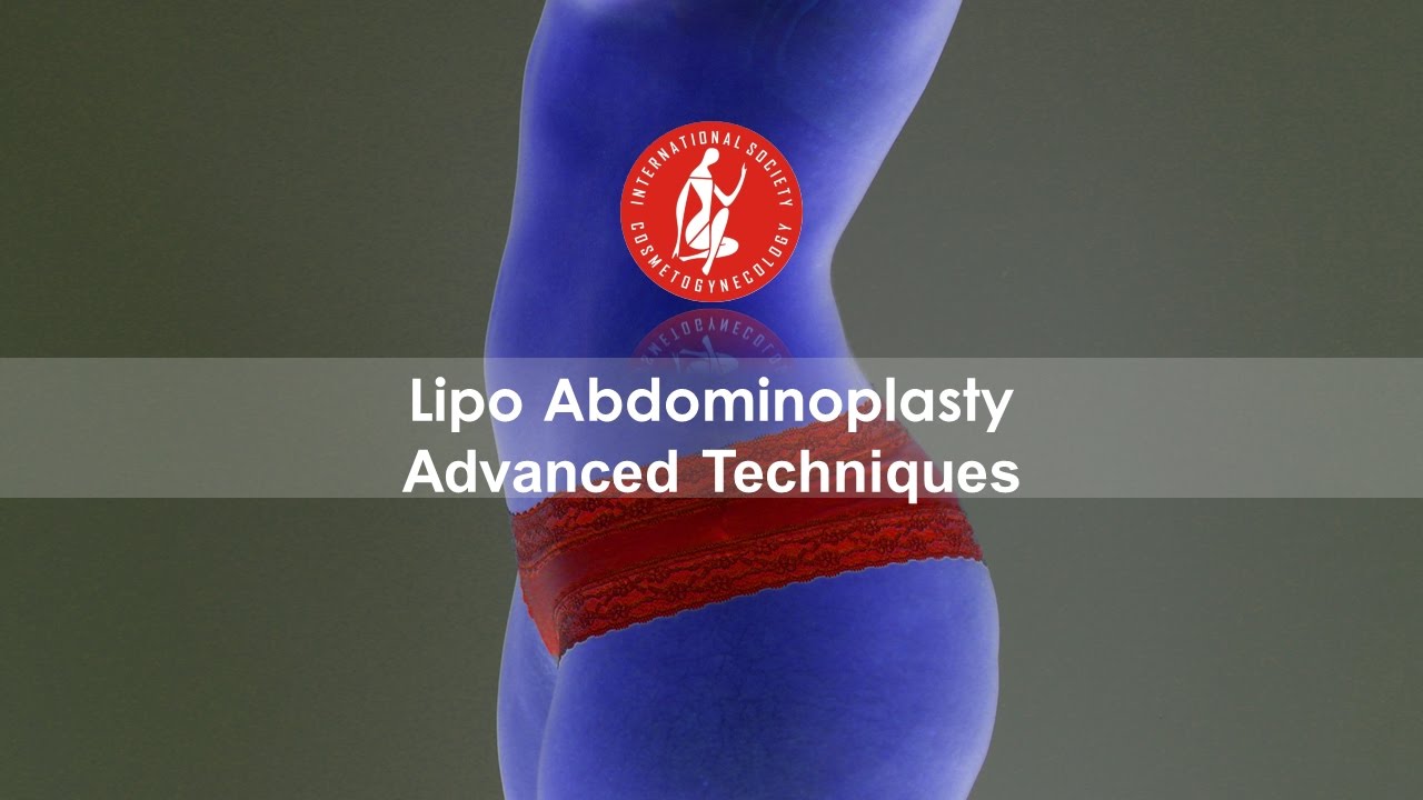Lipo Abdominoplasty Advanced Techniques - YouTube