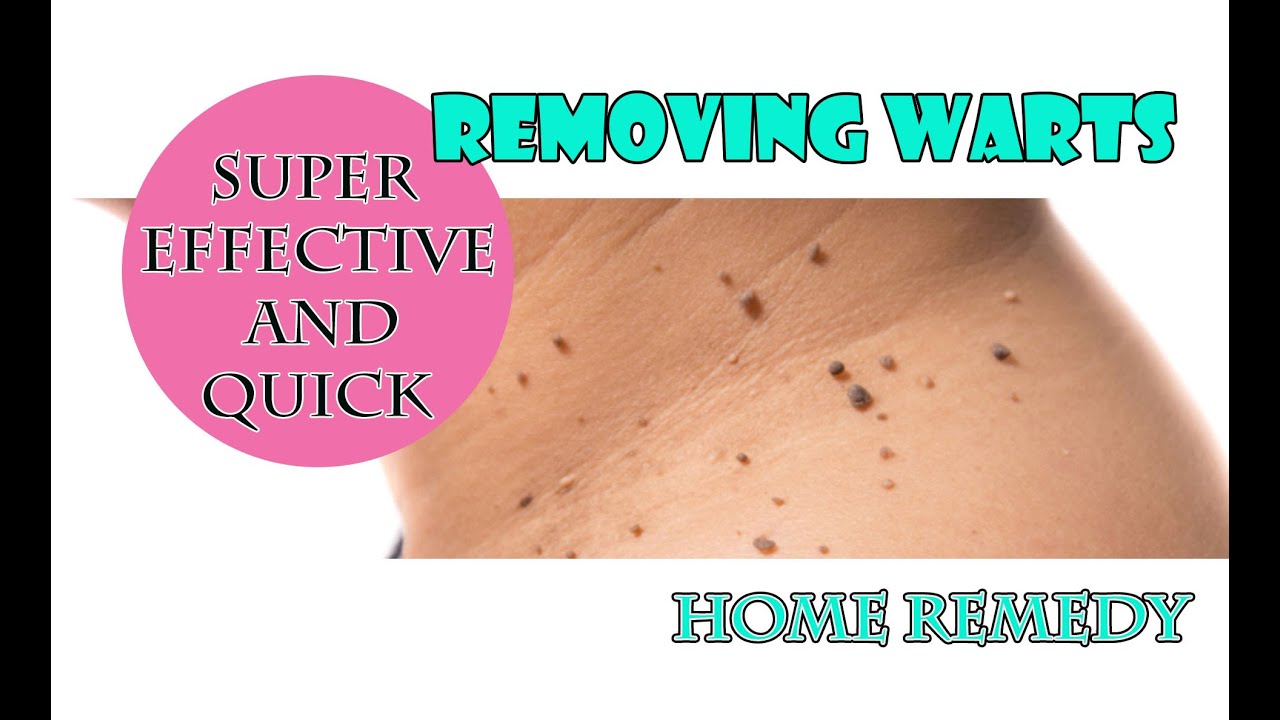 Removing warts. From day 1 to day 2. No pain, Super effective, very ...