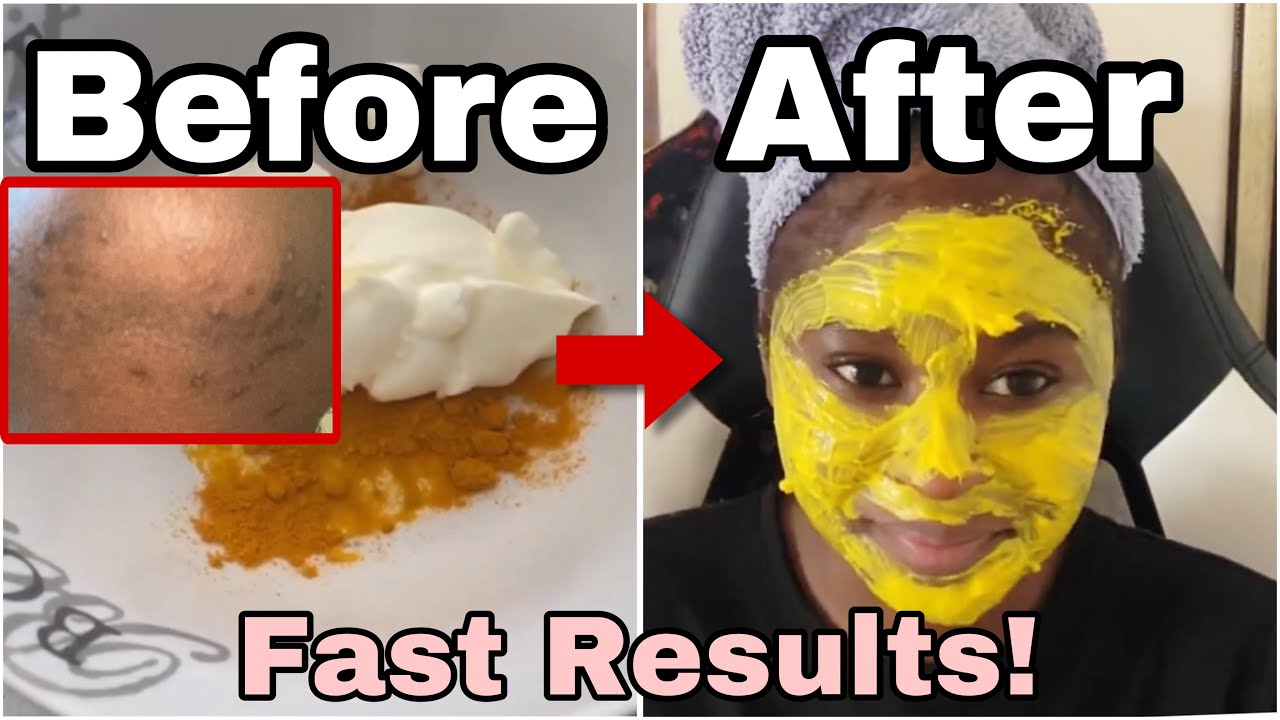 HOW TO GET RID OF DARK SPOTS FAST ON FACE - YouTube