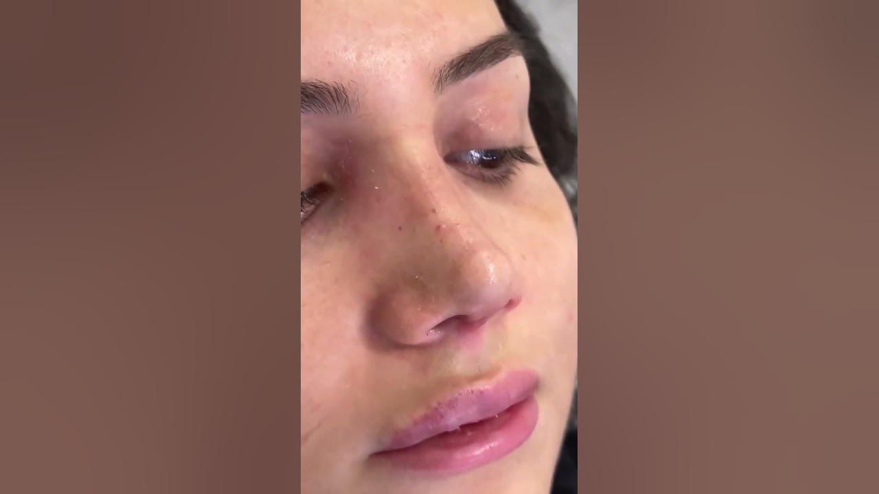 عملية تجميل الانف وتحسين استقامة الحاجز الانفي👃 تجميل تجميلالانفعملياتتجميل تجميلالخشم