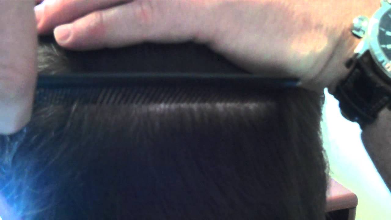Ziering Hair Transplant (Suture Line) - YouTube