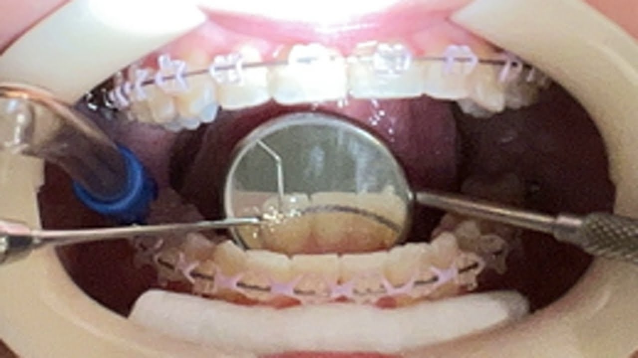 Getting Permanent Retainers On With Braces!!! - YouTube