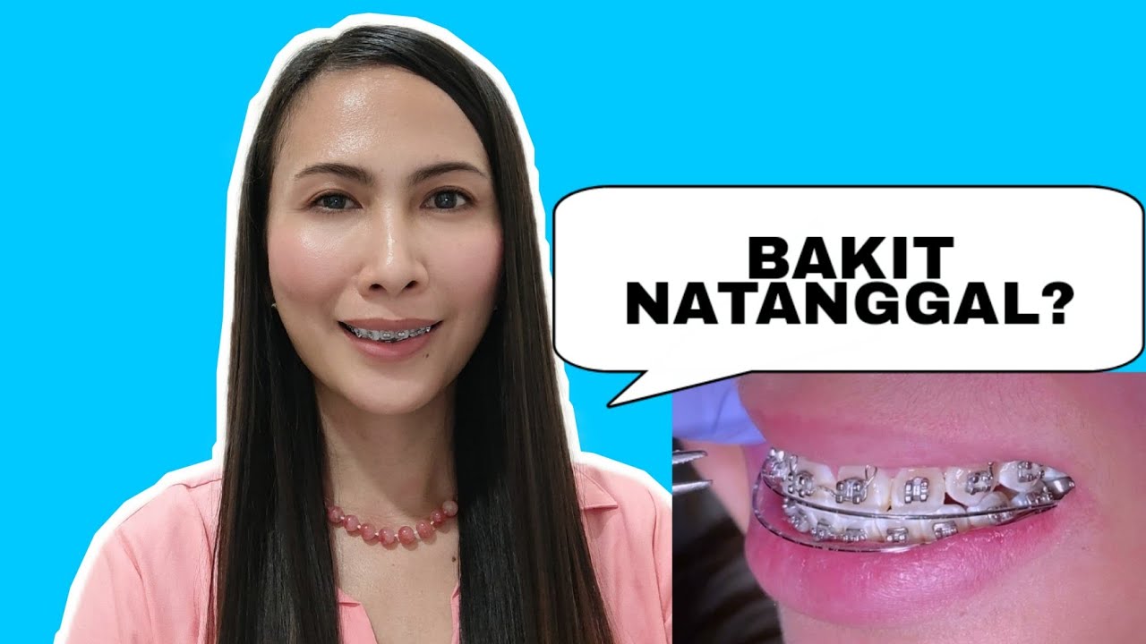 NATANGGAL ANG WIRE AT BRACKET NG BRACES KO AFTER TWO WEEKS! - YouTube