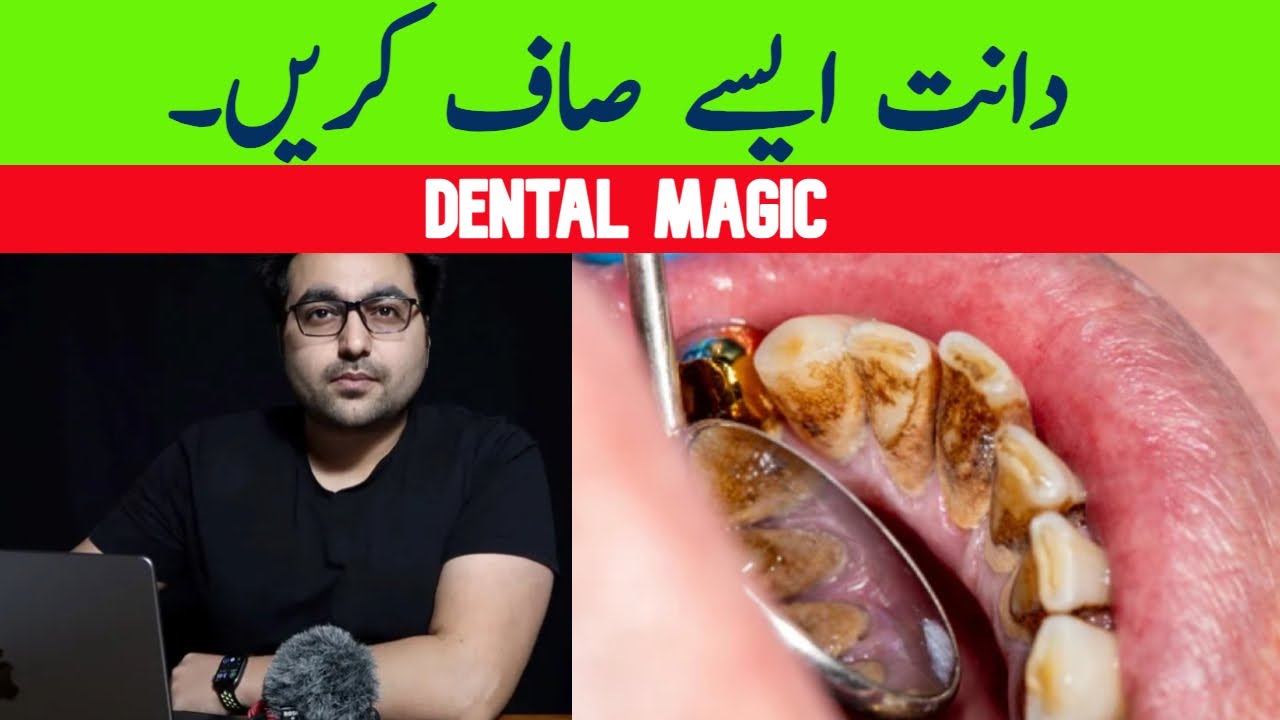 Dr. Zee:The #1 Top Remedy for Dental Plaque अस्वीकार (TARTAR) - YouTube