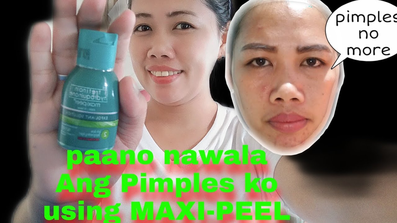 Paano nawala Ang Pimples ko, using maxi-peel - YouTube