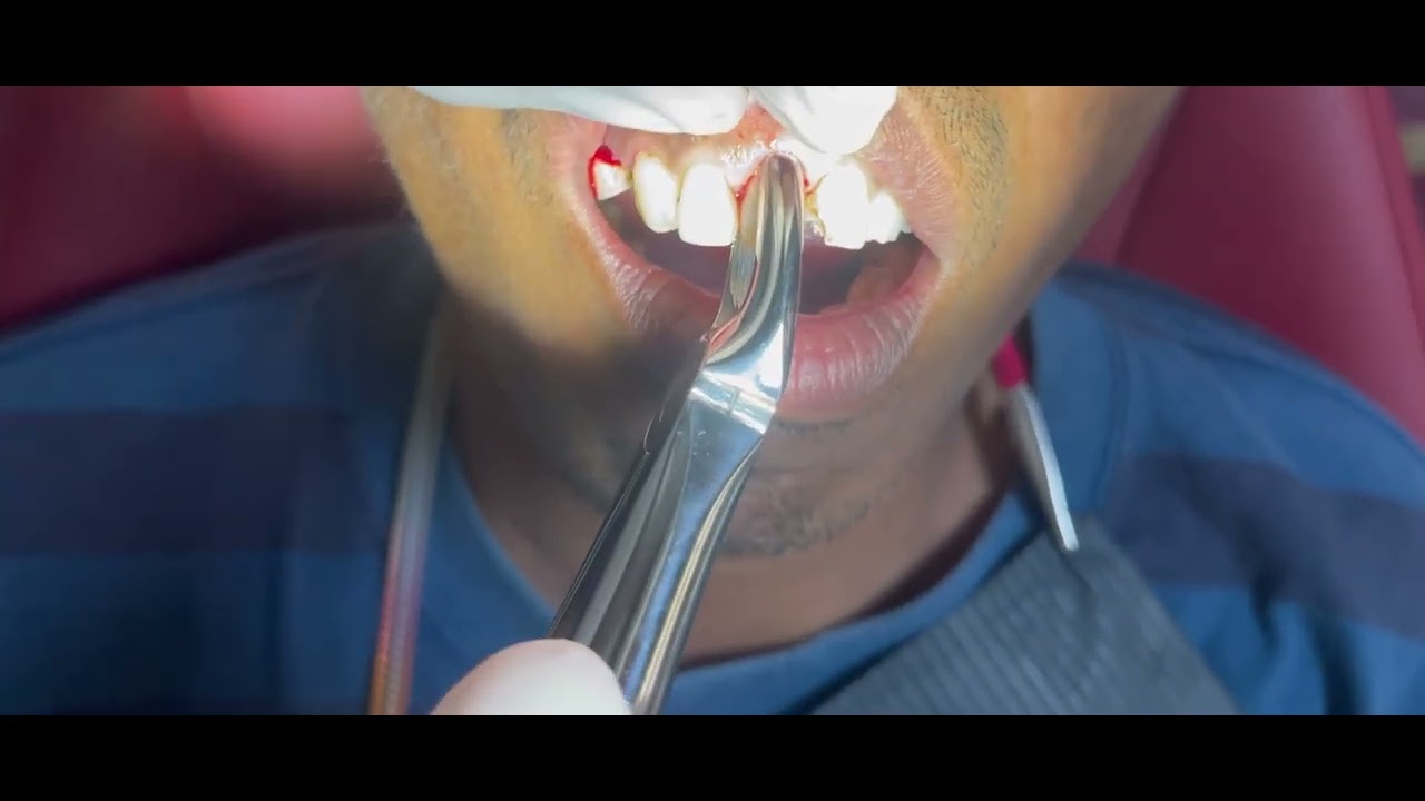Tooth extraction of central incisor #dentist - YouTube