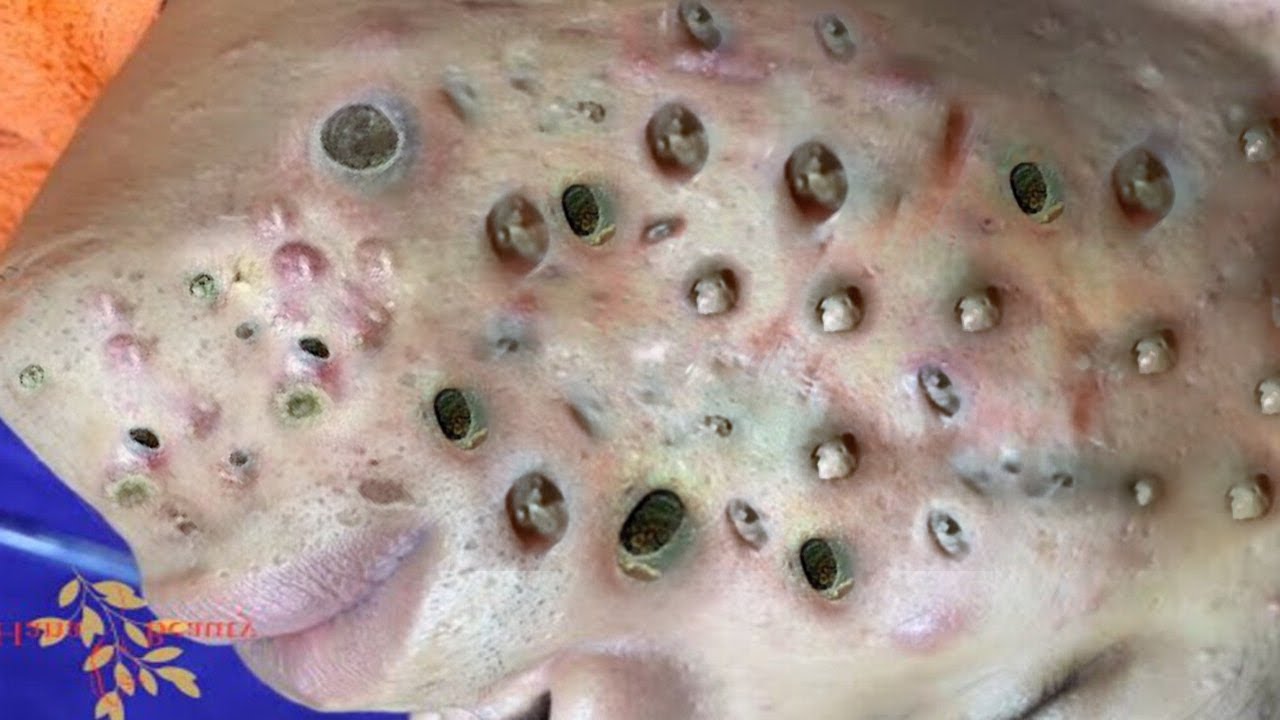 Blackhead Removal With Sac Dep Spa @100074828 - YouTube