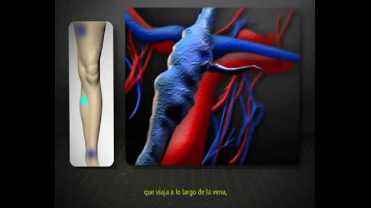 Cirugia laser para varices -Safenectomia Laser-Maracay-Edo Aragua ...